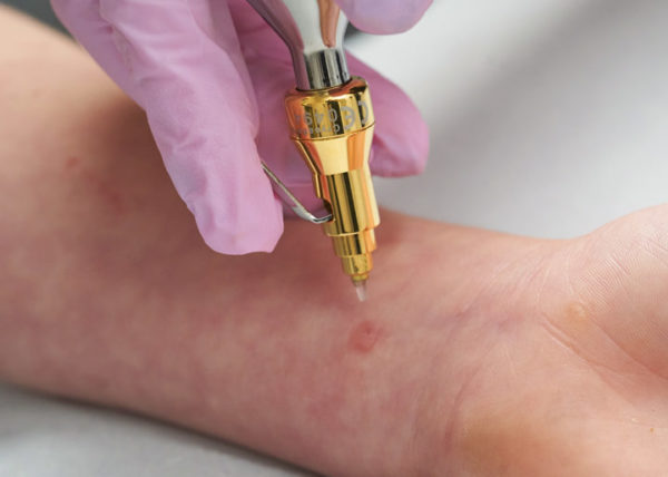 Skin Pigmentation Removal - Laser & Skin Clinic Lincolnshire